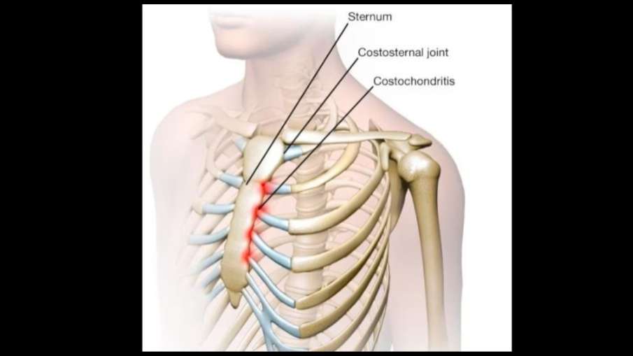 कॉस्टोकॉन्ड्राइटिस क्या है, इसके लक्षण और बचाव | costochondritis ...