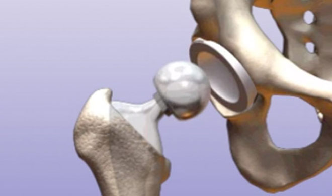 Hip replacement made from 101-year-old able to walk - India TV Hindi