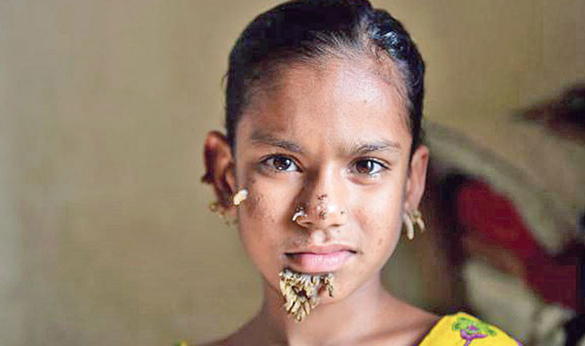 bangladesh treats first case of tree girl syndrome - India TV Hindi