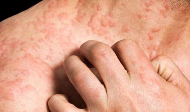 Eczema Types, Treatment, Home Remedies and Symptoms: 2 सप्ताह के अंदर ...