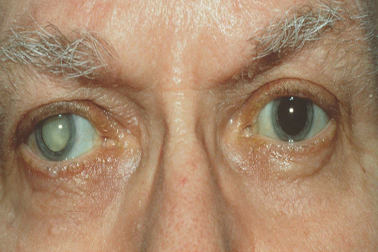Cataract: Types, Causes and Risk Factors: सफेद मोतियाबिंद का नवीनतम ...
