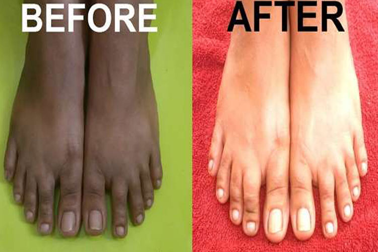 2 minutes feet whitening pedicure that can remove sun tan instantly ...