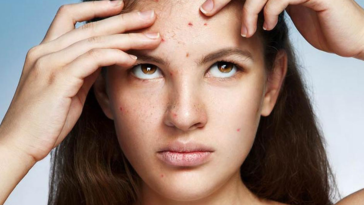 wrong eating bad habits and stress is directly related with acne and ...