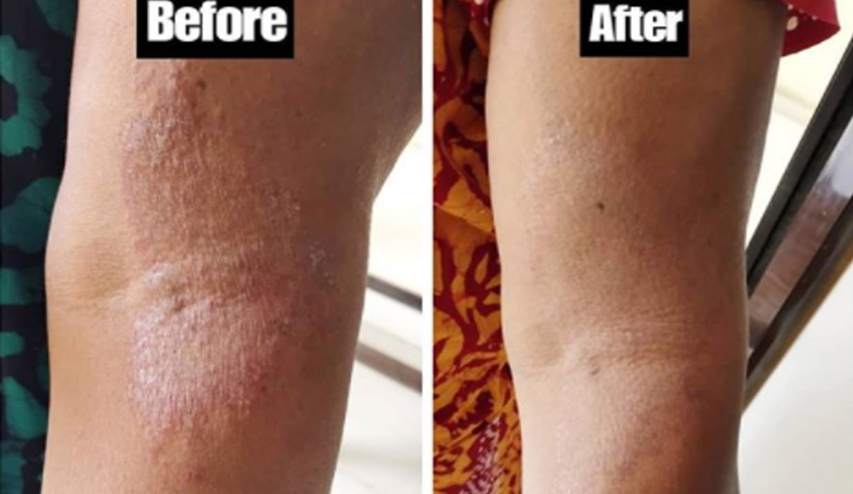 Home Remedies For Ringworm How To Get Rid Of Ringworm Eczema And ...