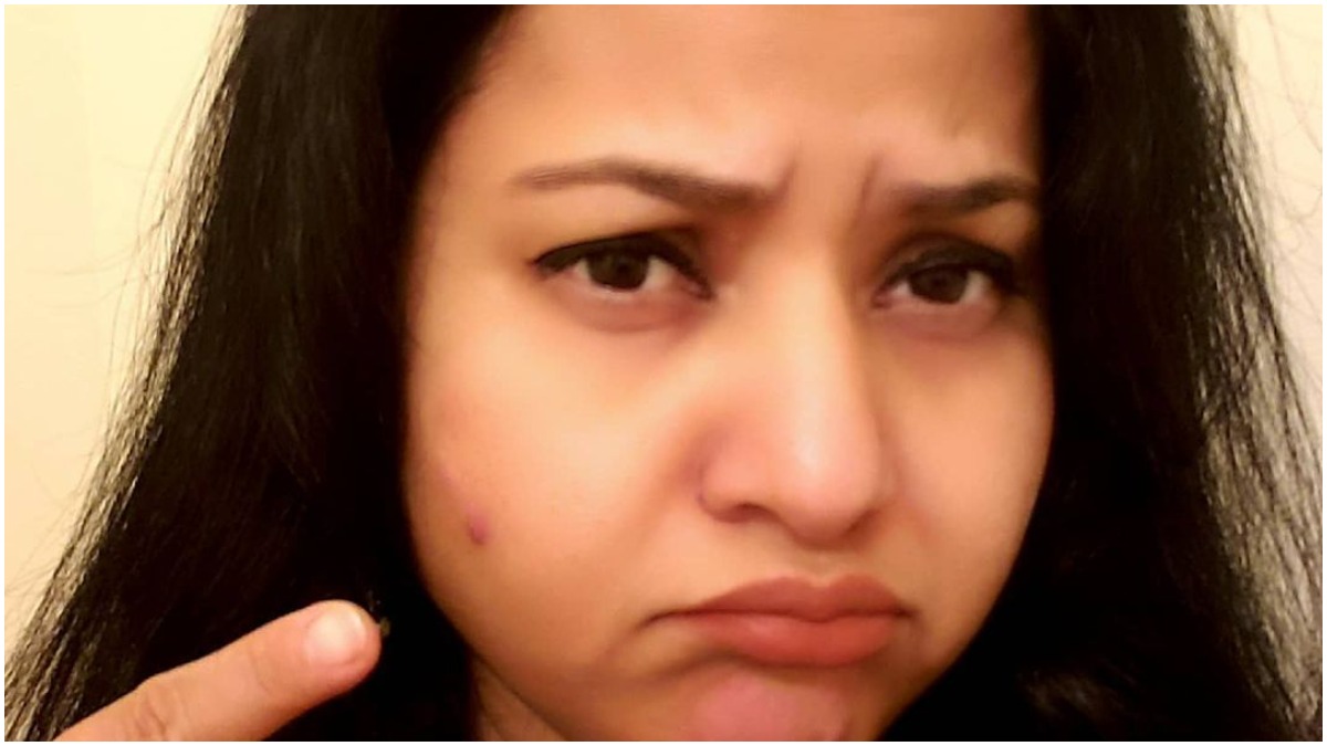 Eating oily and junk food causes pimples on face try home remedies for ...