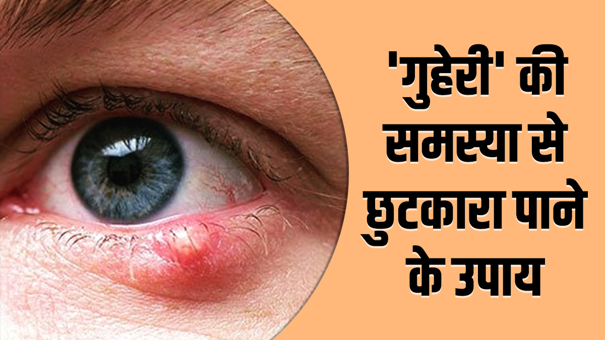 आंखों में होने वाली फुंसी या गुहेरी का घर पर ऐसे करें इलाज, मिलेगी राहत ...