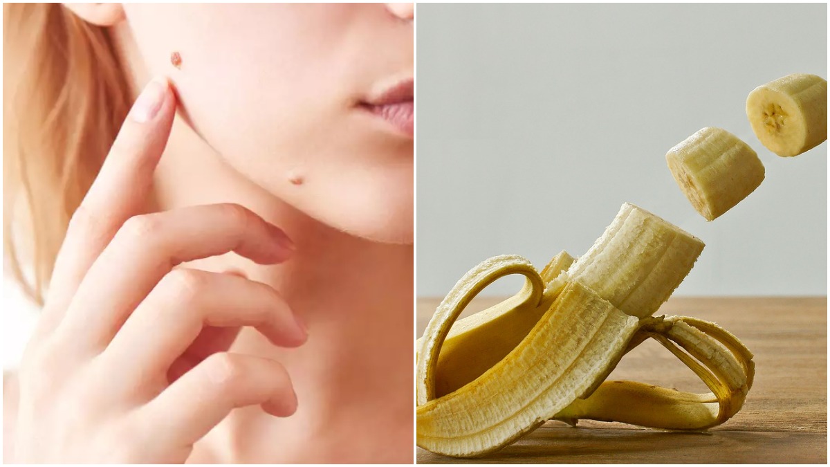 Best way to remove warts fast Home remedies face mole masso massa ki ...