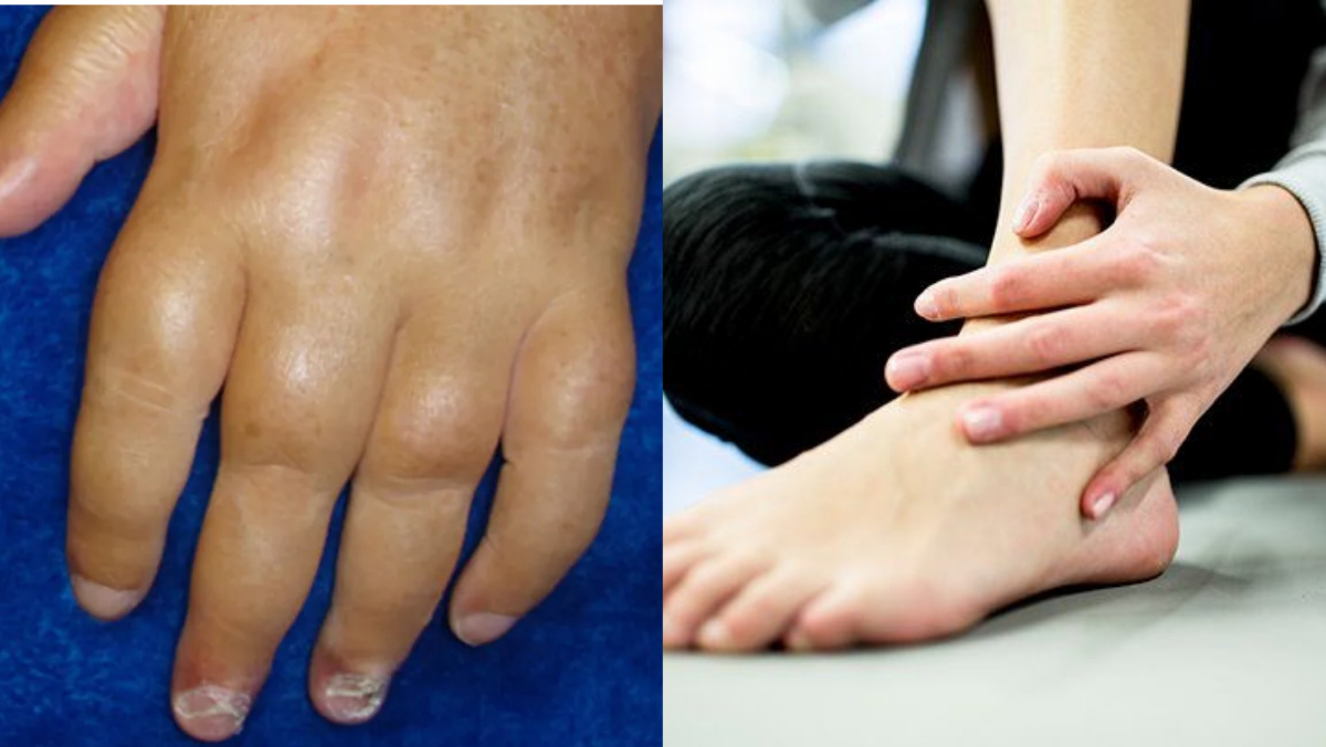 गठिया के लक्षण: गठिया से पहले शरीर के इन अंगों में नजर आते हैं 3 बदलाव ...