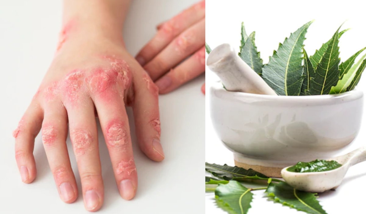 Neem Oil Home Remedies Tips Is Effective In Daad Khaj Khujli Ringworm Problem Know In Hindi दाद