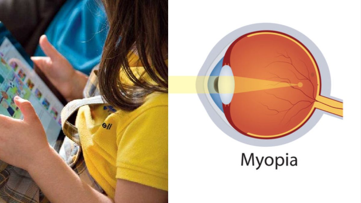 Smart phone addiction making children victims of myopia cases increased ...