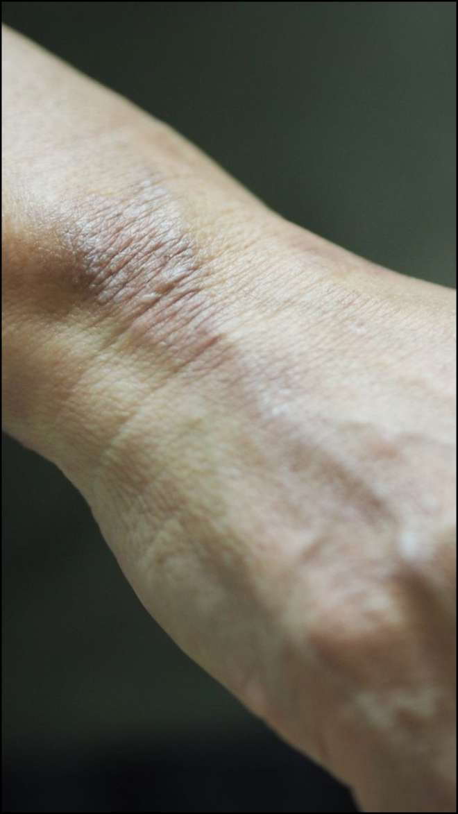 कुष्ठ रोग के क्या हैं लक्षण? - India TV Hindi