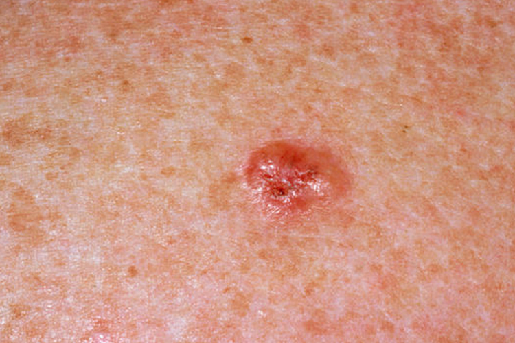 Skin Cancer Symptoms: Pictures of Skin Cancer and Precancerous: स्किन ...